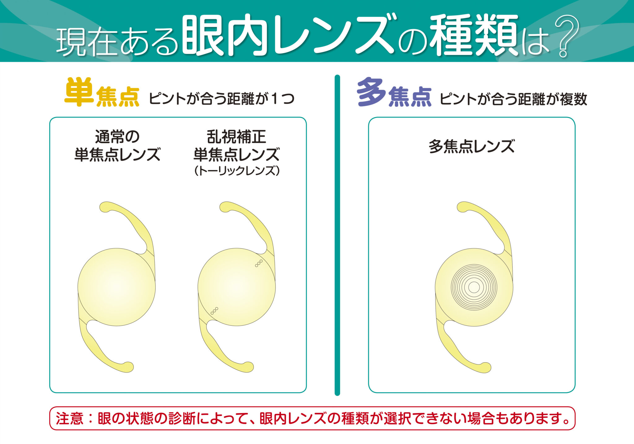 眼内レンズの種類と特徴とは？ - ライトアジャスタブルレンズ LAL｜中京眼科